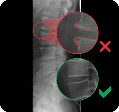 SPONDILOZA - Re.aktiv
